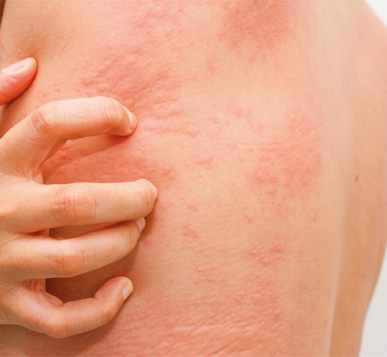 Itchy Skin And Eczema Quick Guide 7 Top Treatment Tips Yan Yee